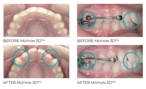 Carriere Motion - Biotech Dental
